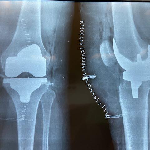 ΡΟΜΠΟΤΙΚΗ ΑΡΘΡΟΠΛΑΣΤΙΚΗ ΓΟΝΑΤΟΣ & ΙΣΧΙΟΥ ΜΑΚΟ – Για 1η Φορά στη ...